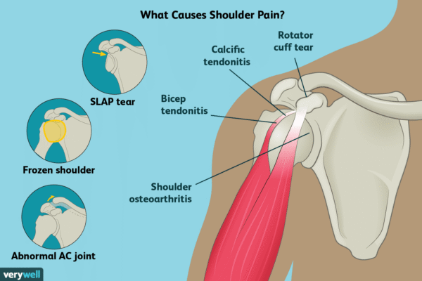 What Is The Recovery Time of Stem Cell Therapy For Shoulders?